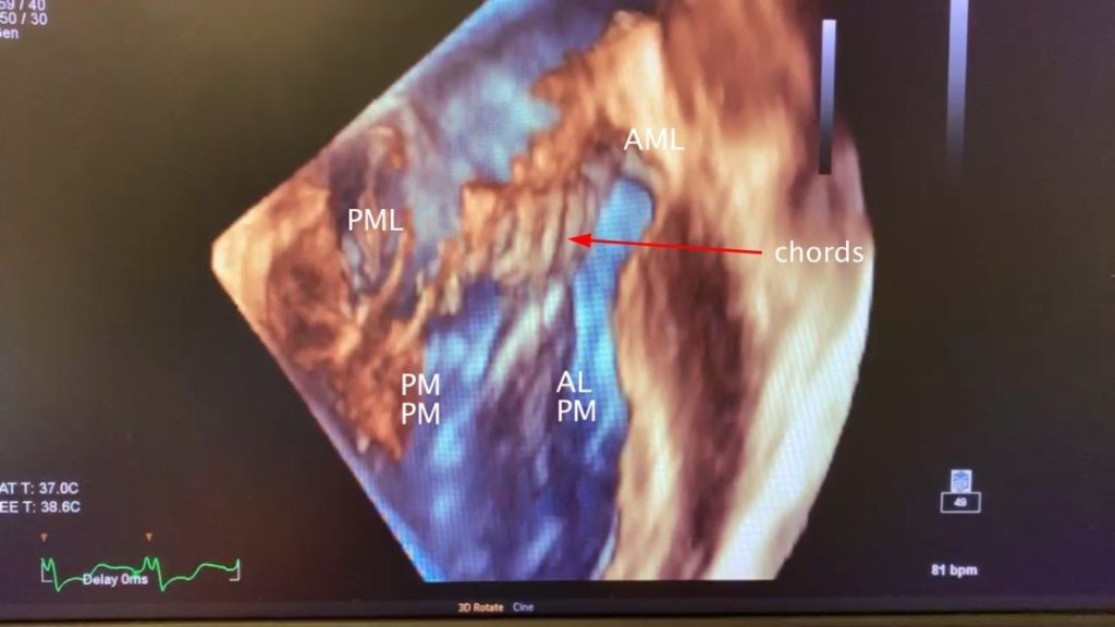 figure-3 - Congenital Cardiac Anesthesia Society