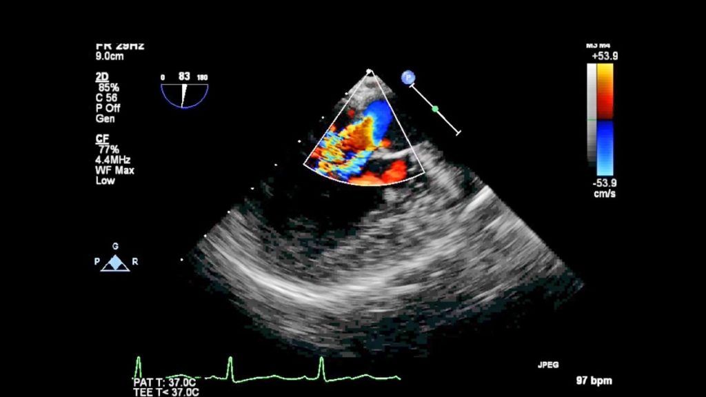 Part 2 - Transesophageal Echocardiography in Congenital Mitral Valve ...