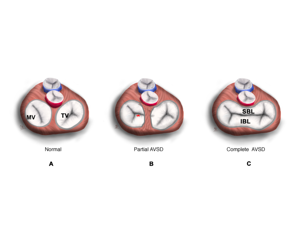 Part 2 - Transesophageal Echocardiography in Congenital Mitral Valve ...